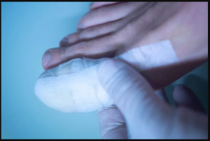 Cartiva toe implant failure lawsuit investigation 2023: Is It a Scam ...